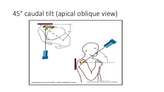 Fracture and dislocation of the shoulder girdle
