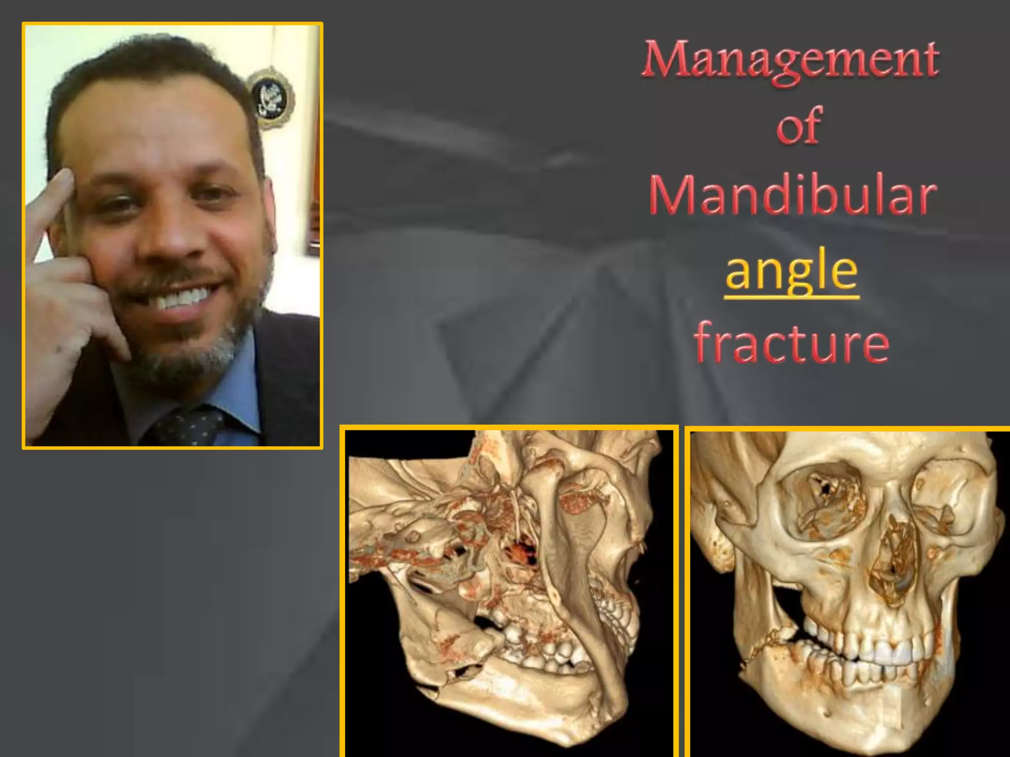 Fracture mandibular angle | PPSX