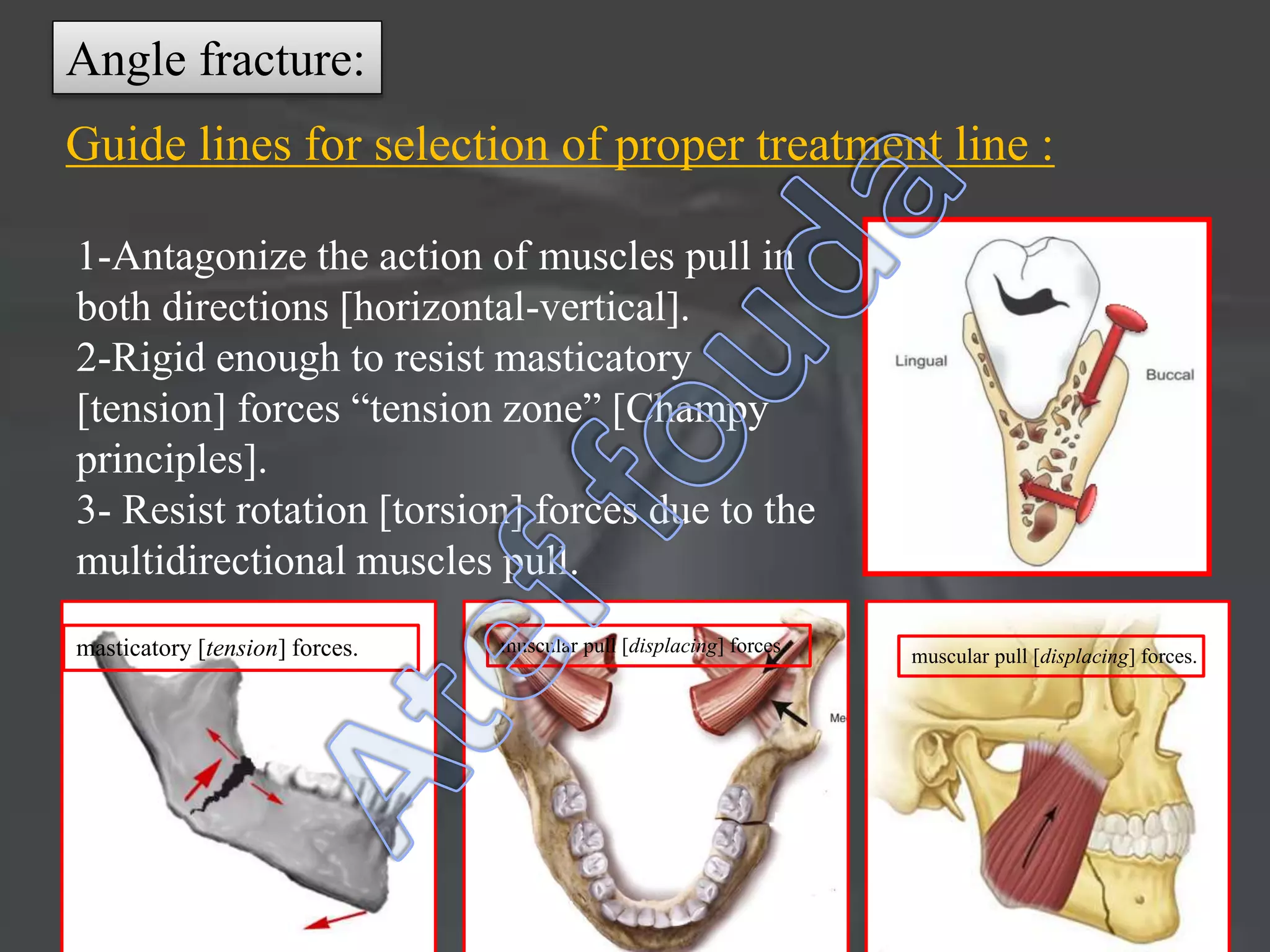 Fracture mandibular angle | PPSX