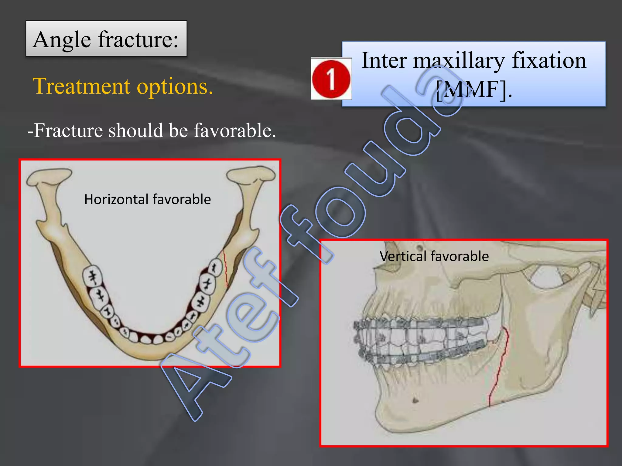 Fracture mandibular angle | PPSX