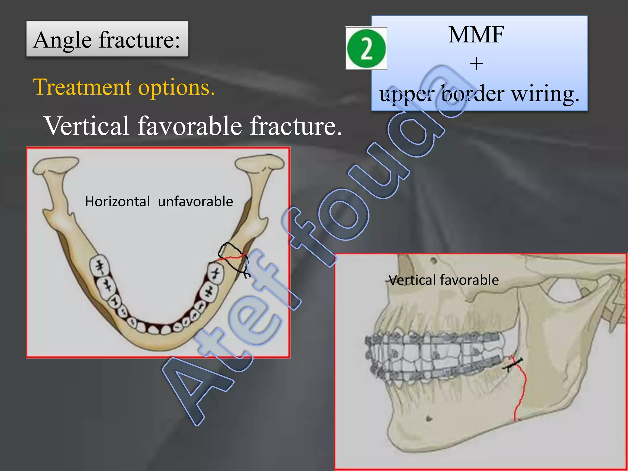 Fracture mandibular angle | PPSX