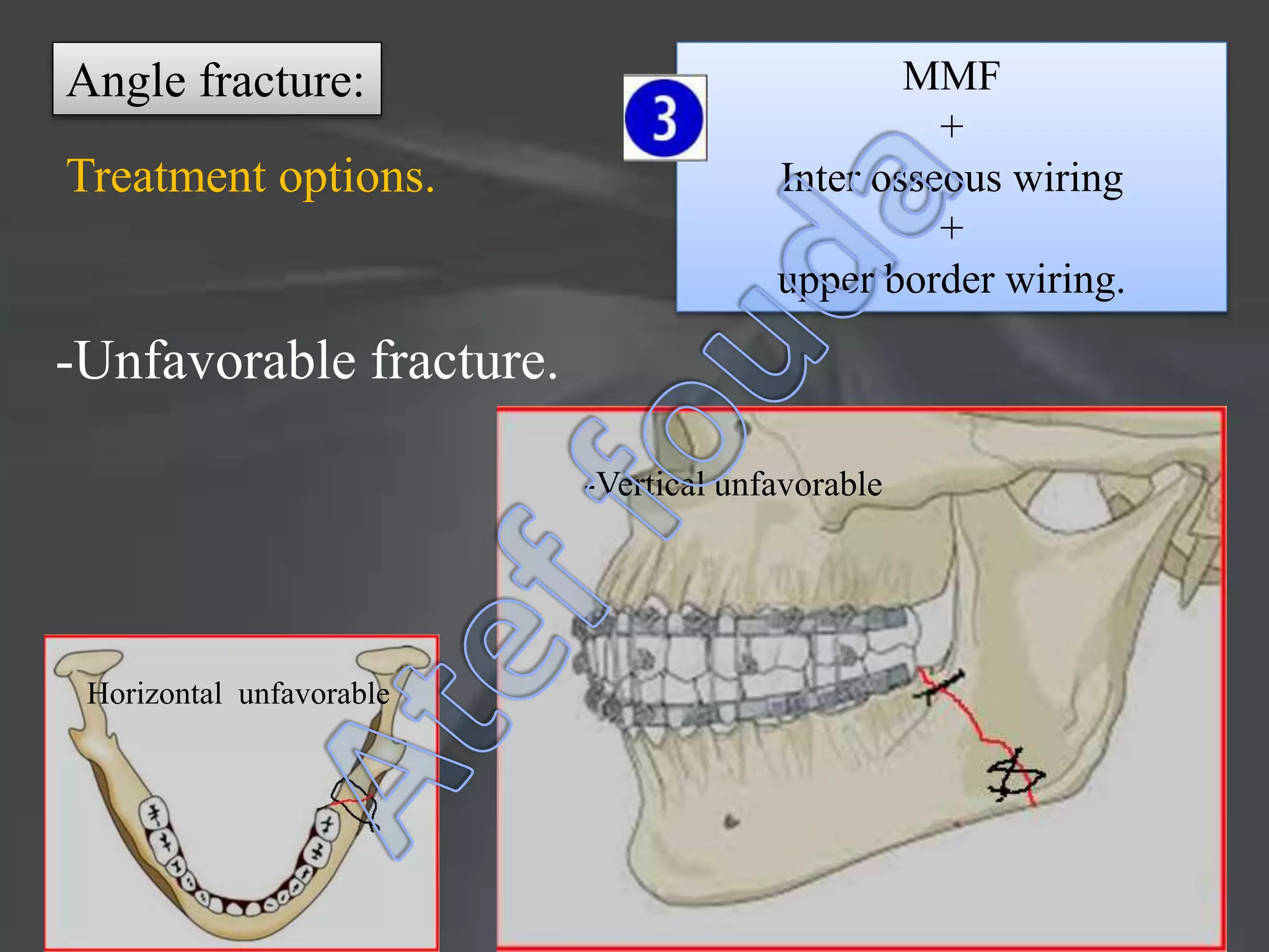 Fracture mandibular angle | PPSX