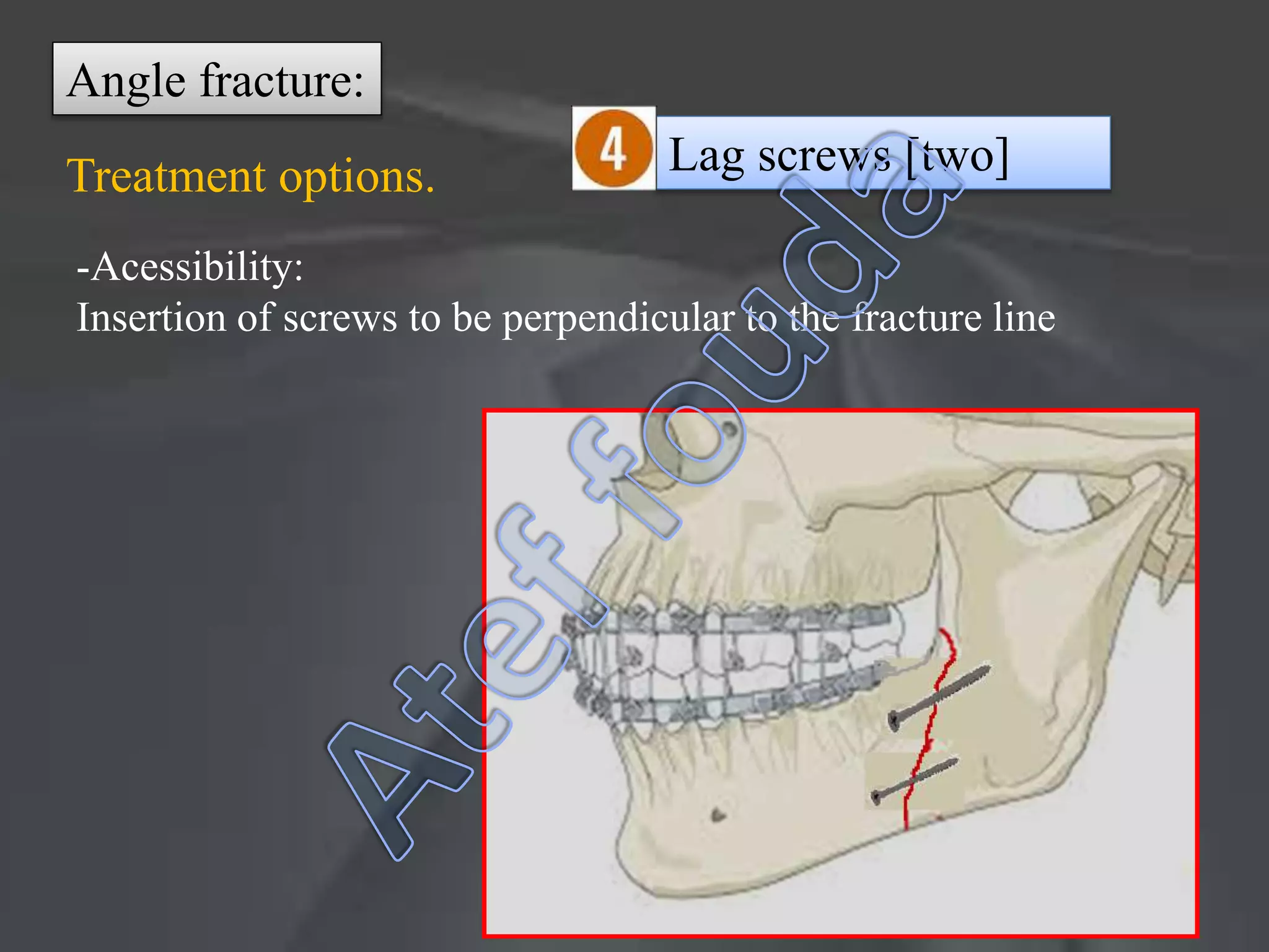Fracture mandibular angle | PPSX