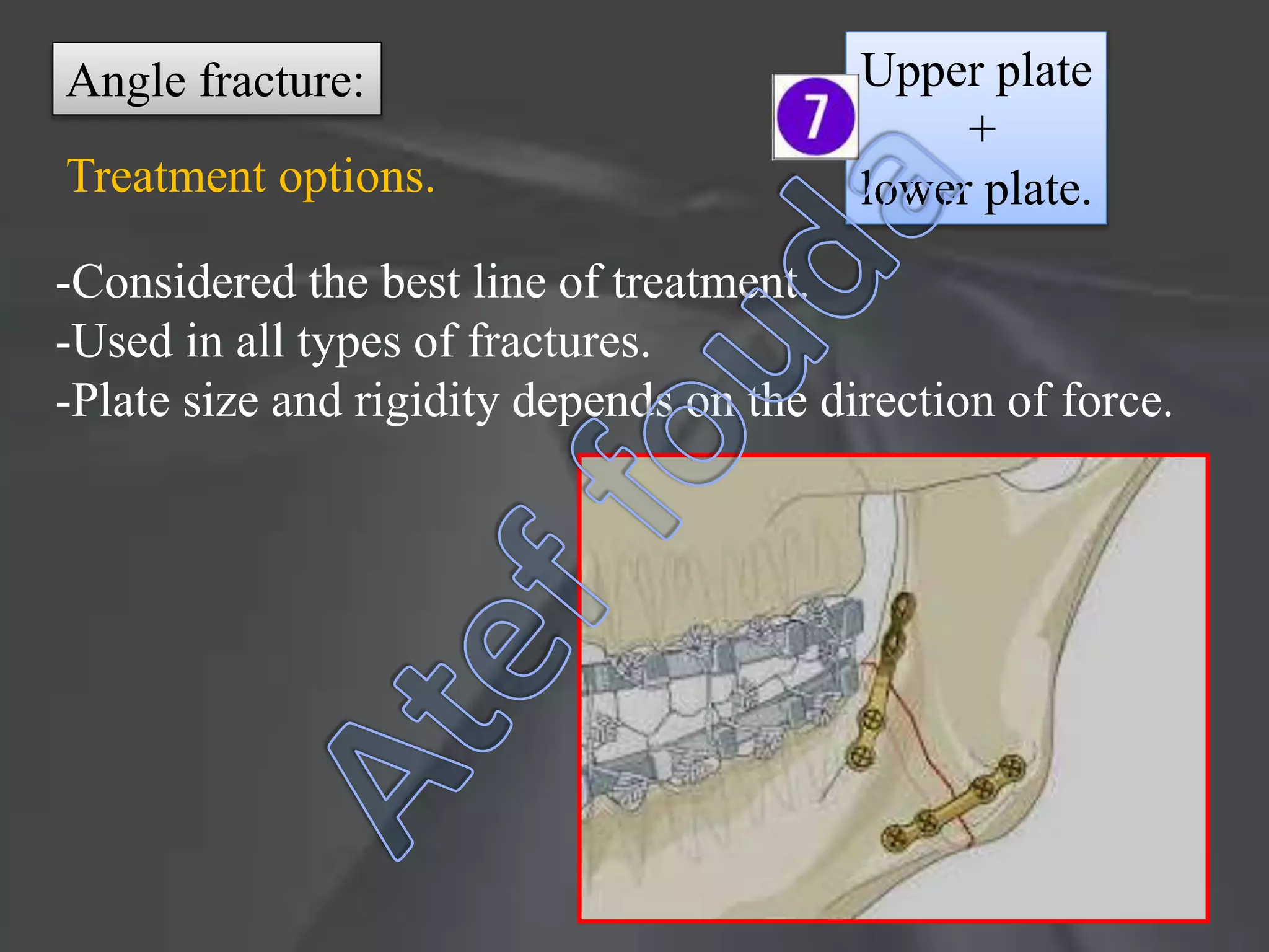 Fracture mandibular angle | PPSX