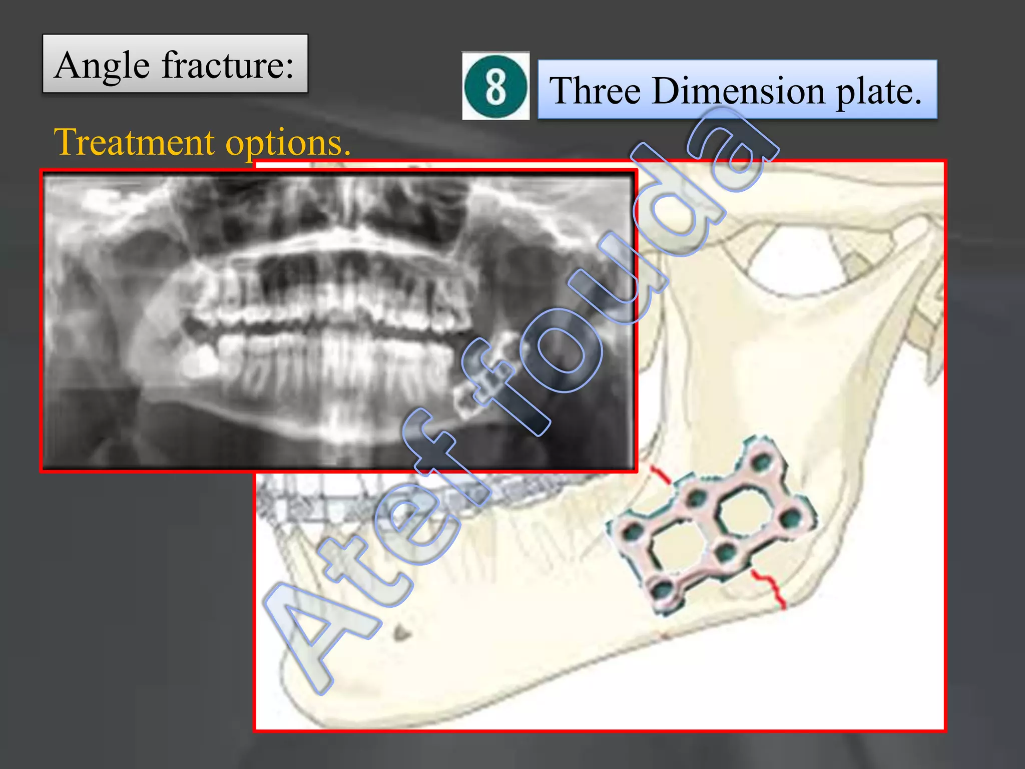 Fracture mandibular angle | PPSX