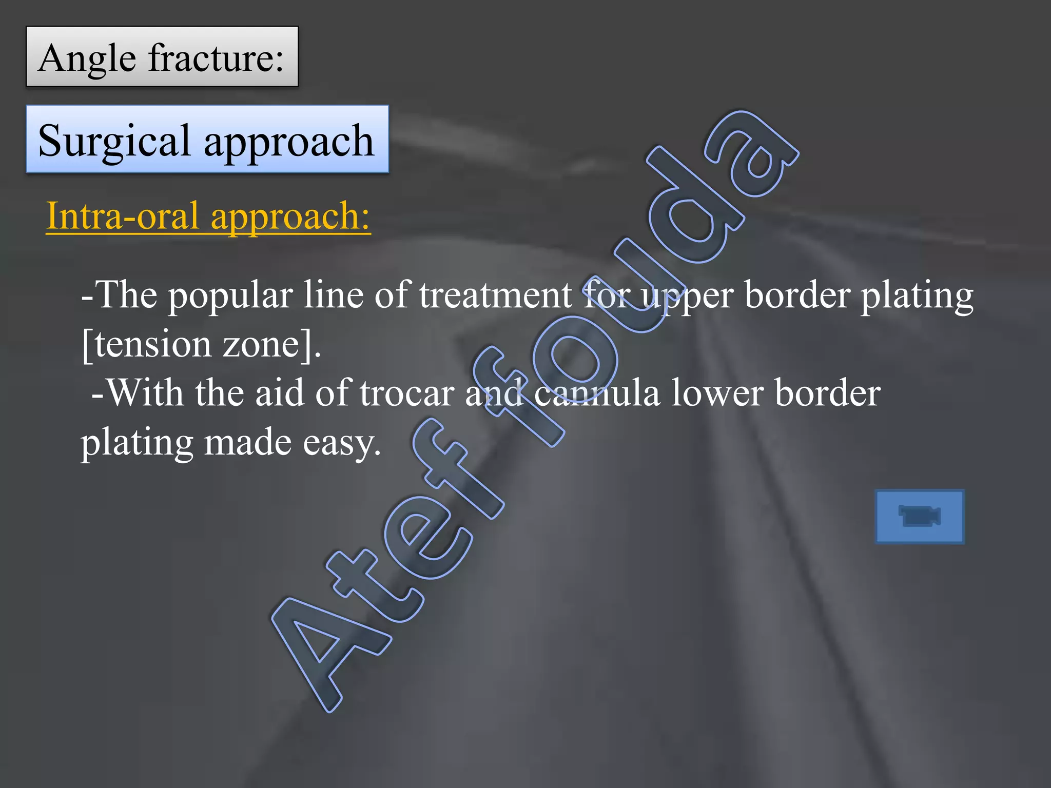 Fracture mandibular angle | PPSX