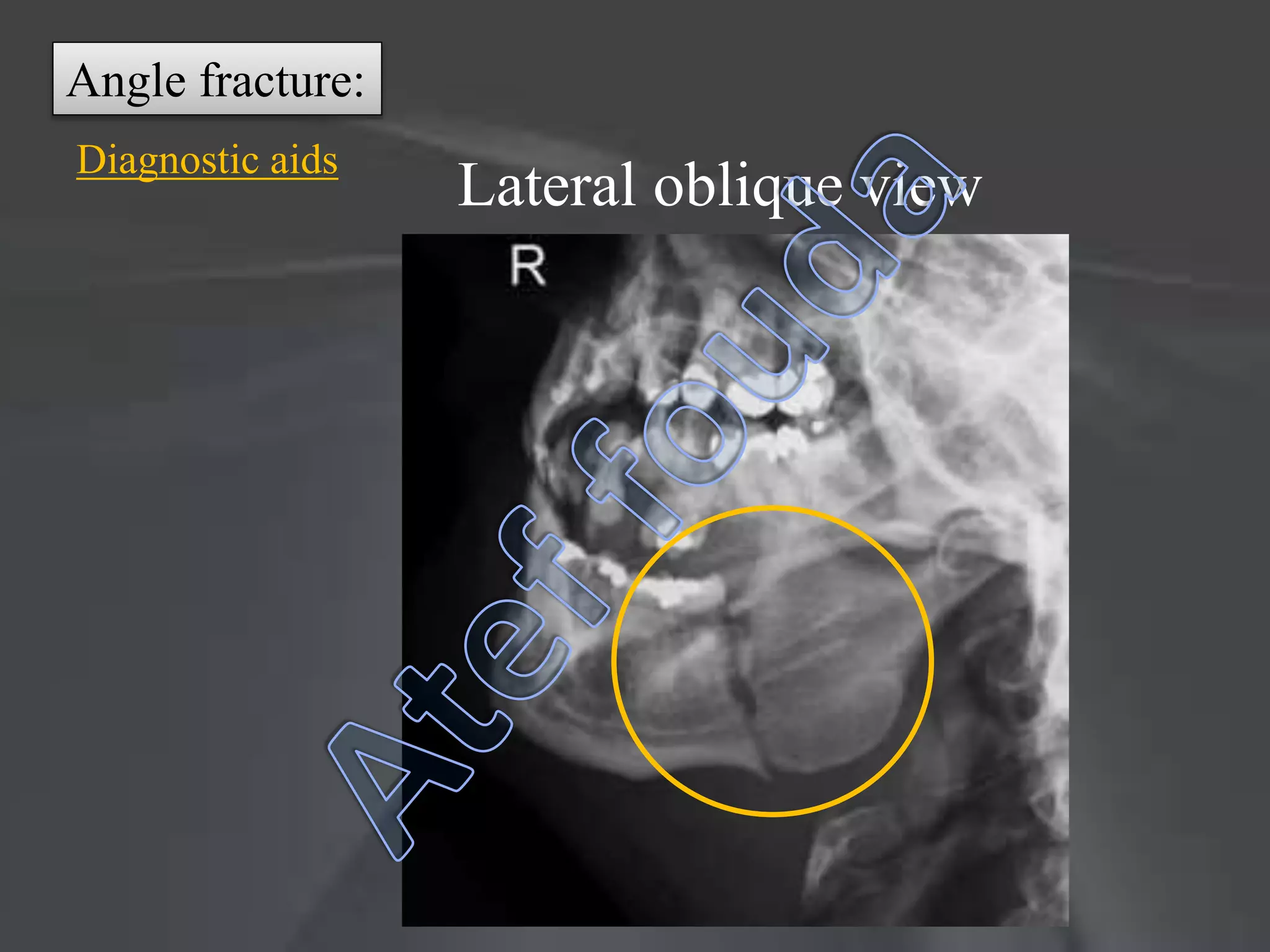 Fracture mandibular angle | PPSX