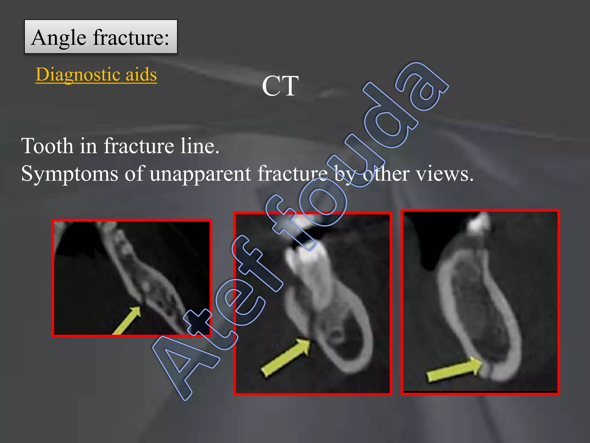 Fracture mandibular angle | PPSX