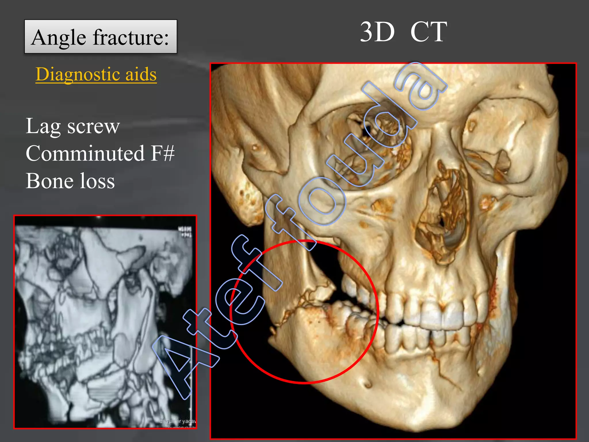 Fracture mandibular angle | PPSX