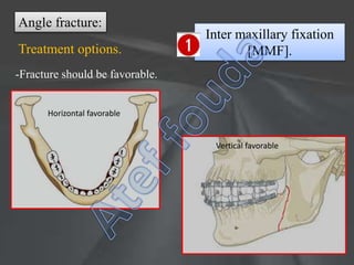 Fracture mandibular angle | PPSX