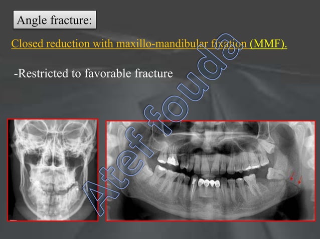 Fracture mandibular angle | PPT