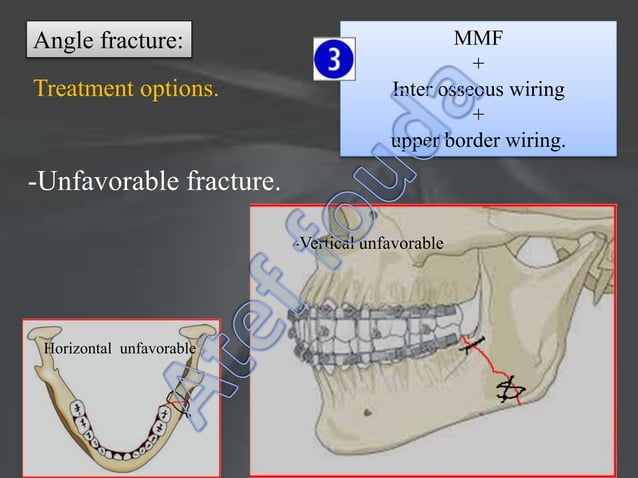 Fracture mandibular angle | PPT