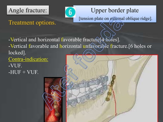 Fracture mandibular angle | PPSX