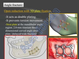 Fracture mandibular angle | PPSX