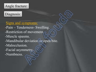 Fracture mandibular angle | PPSX