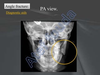 Fracture mandibular angle | PPSX