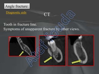 Fracture mandibular angle | PPSX