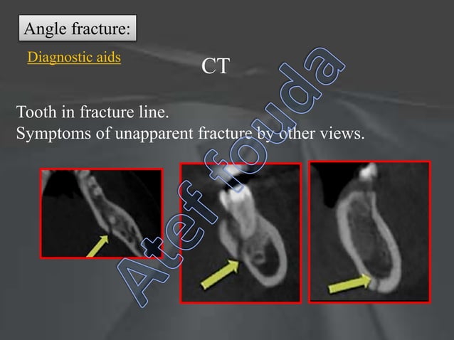 Fracture mandibular angle | PPSX