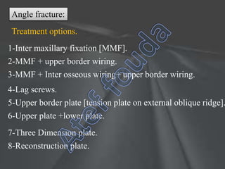 Fracture mandibular angle | PPSX
