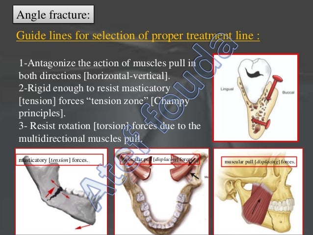Fracture mandibular angle