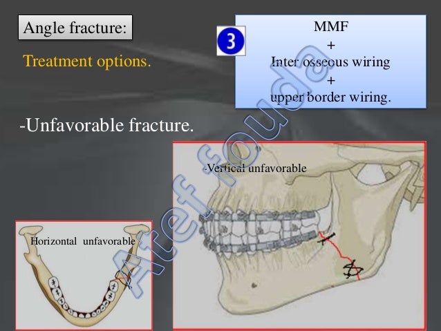 Fracture mandibular angle