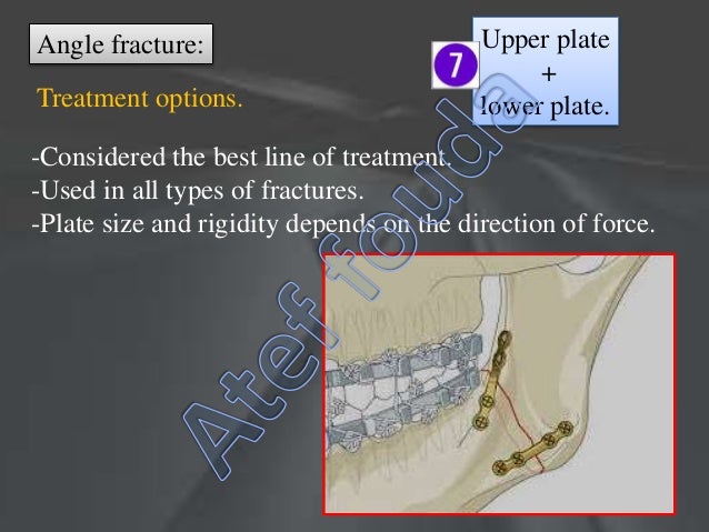 Fracture Mandibular Angle