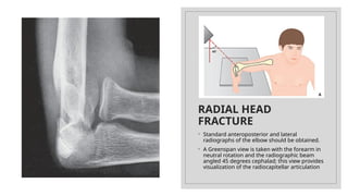 FRACTURE ANTEBRACHII DR.XIN v210520.1300.pptx