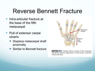 Reverse Bennett Fracture