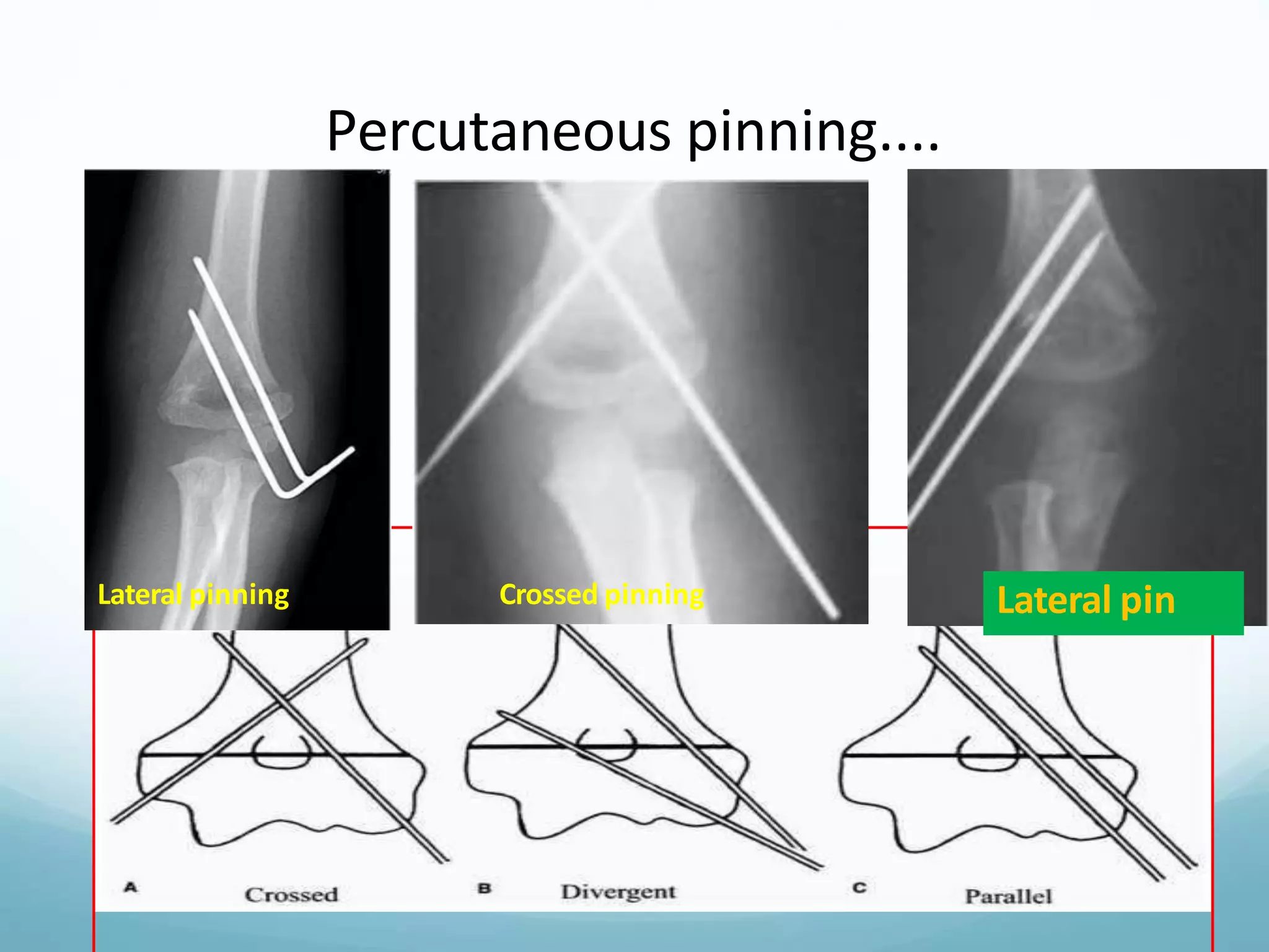 Fracture around elbow.pptx