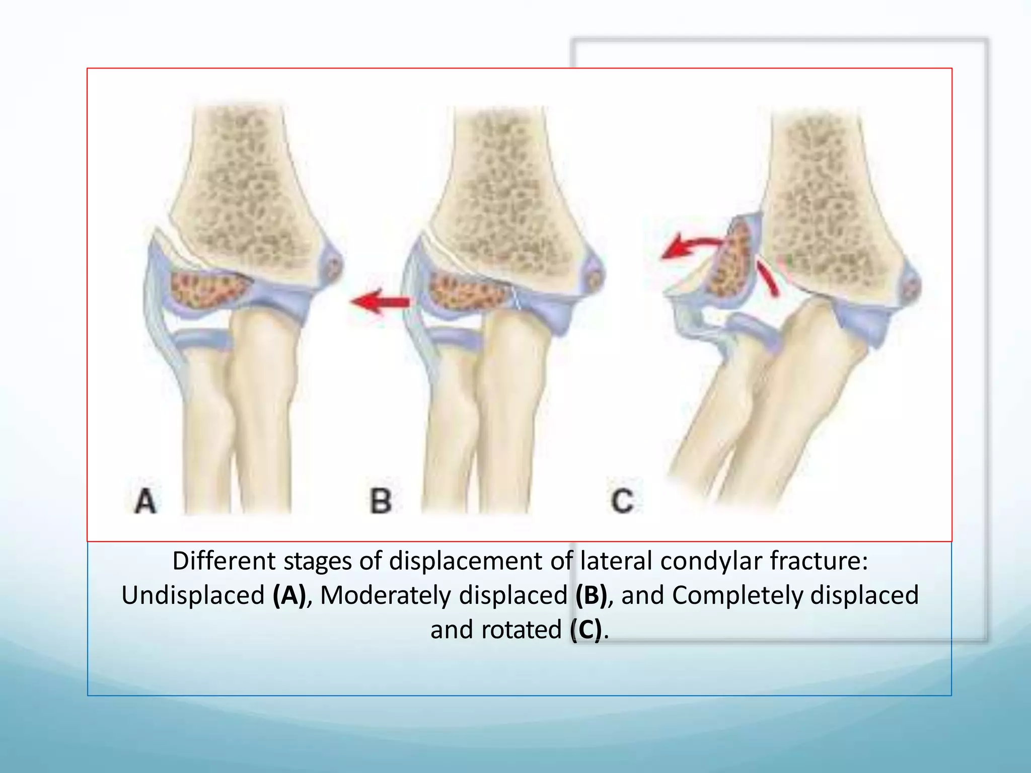 Fracture around elbow.pptx