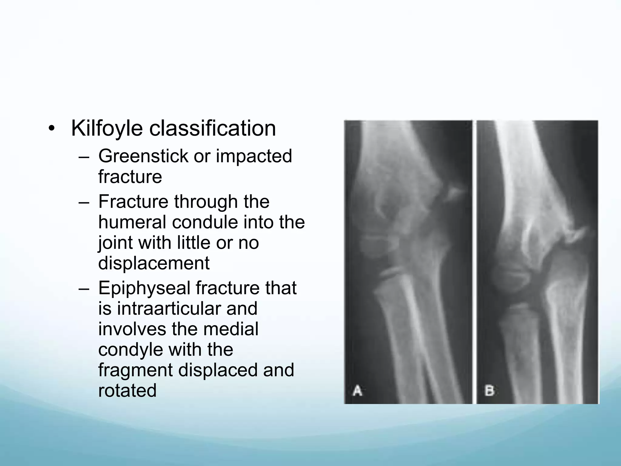 Fracture around elbow.pptx
