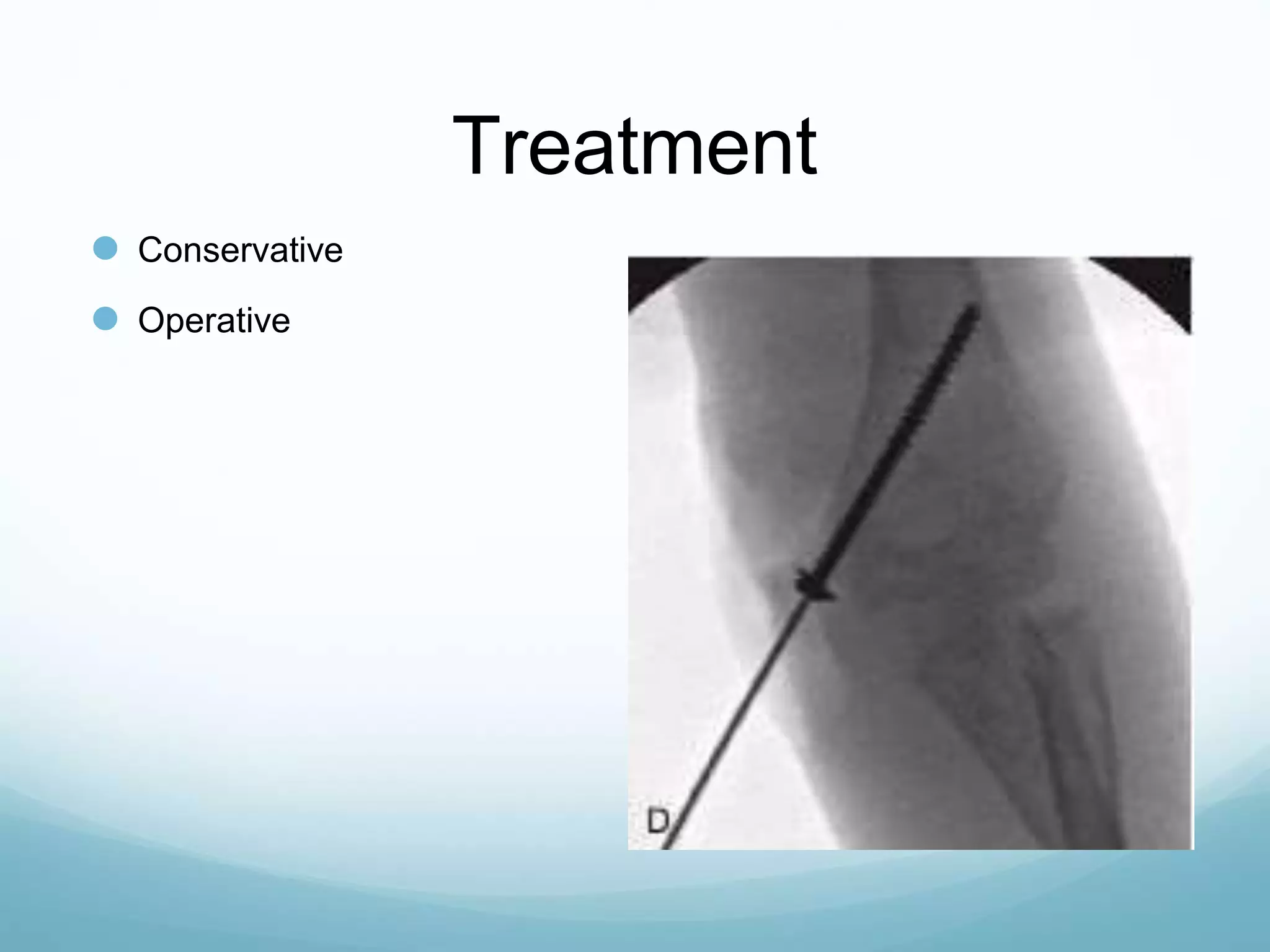 Fracture around elbow.pptx