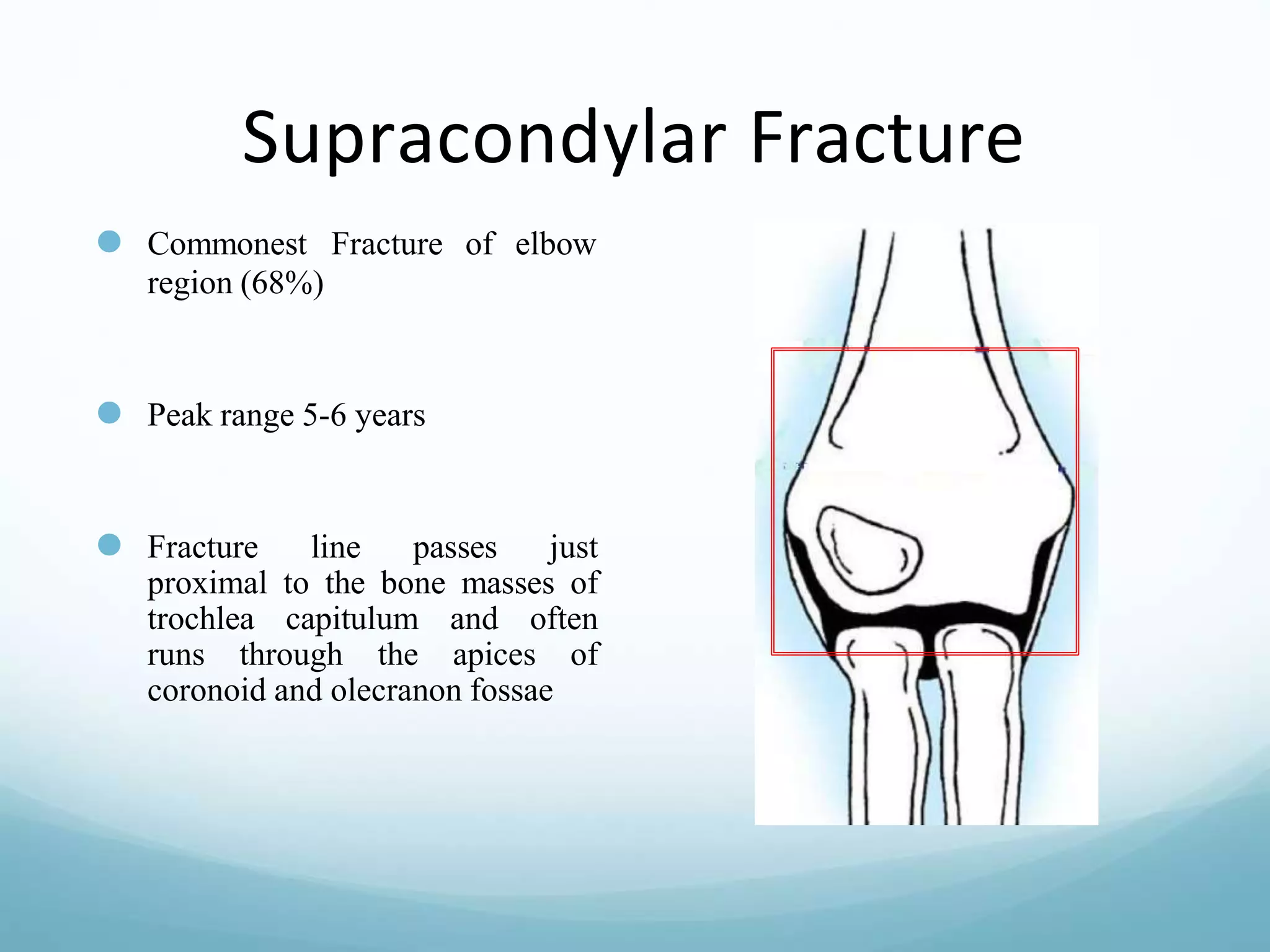 Fracture around elbow.pptx