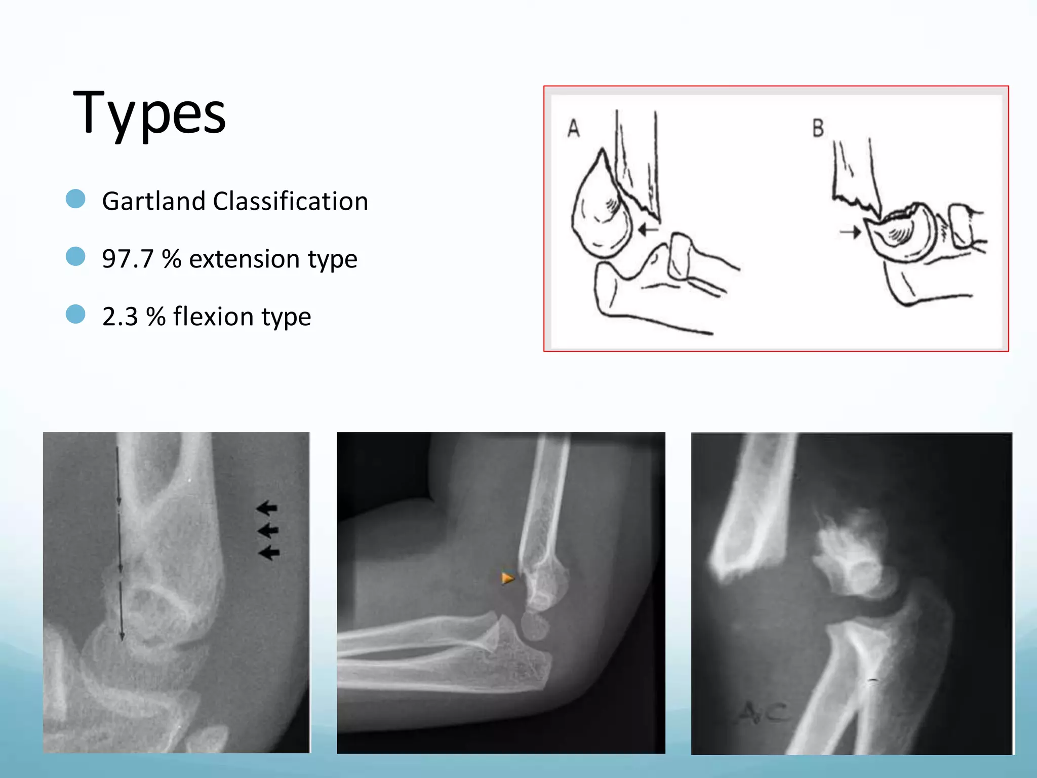 Fracture around elbow.pptx