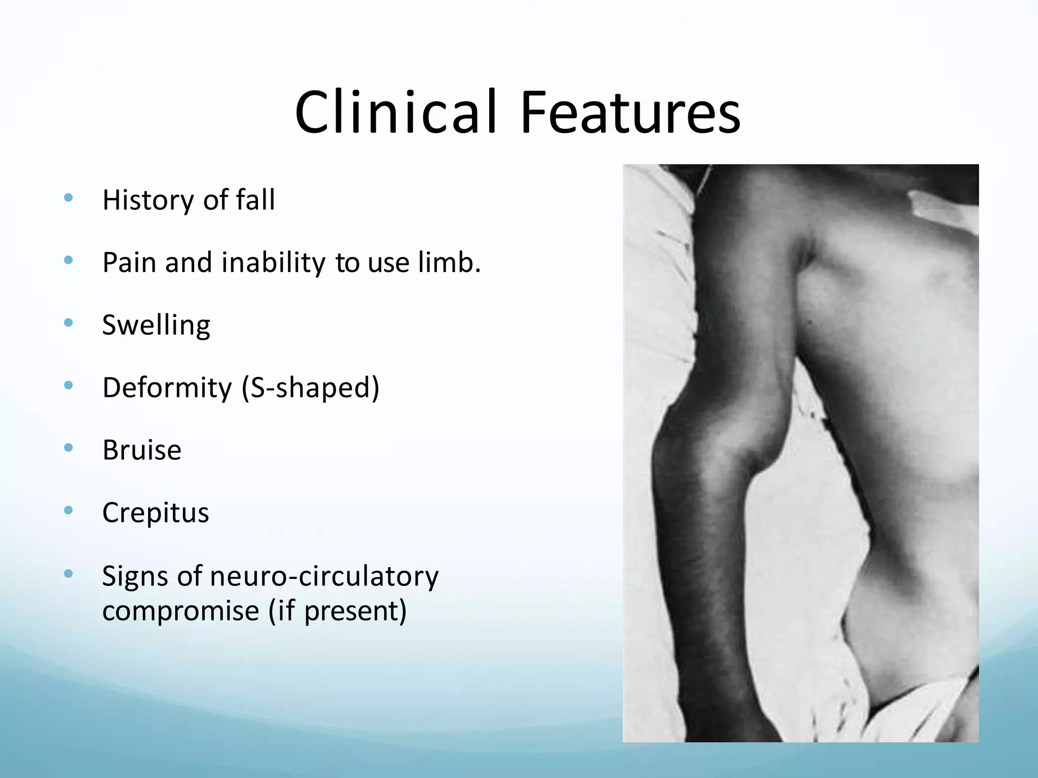 Fracture around elbow.pptx