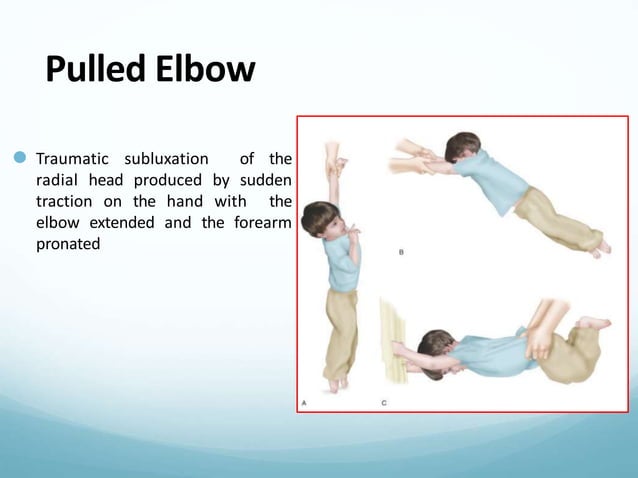 Fracture around elbow.pptx