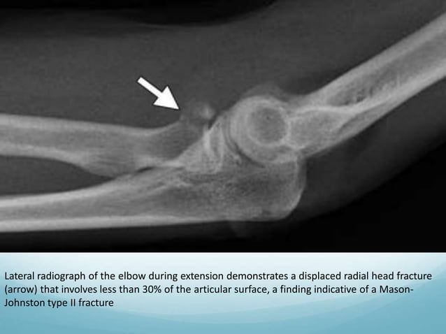 Fracture around elbow.pptx