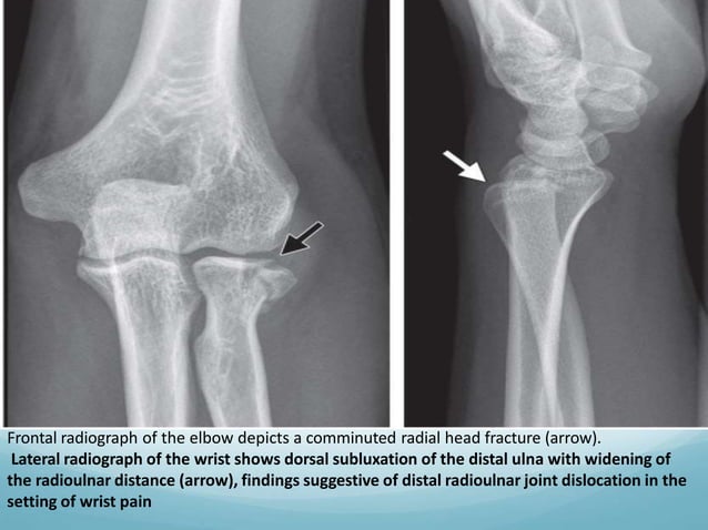Fracture around elbow.pptx