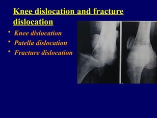 Fracture Around the Knee management.pptx