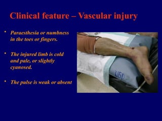 Fracture Around the Knee management.pptx