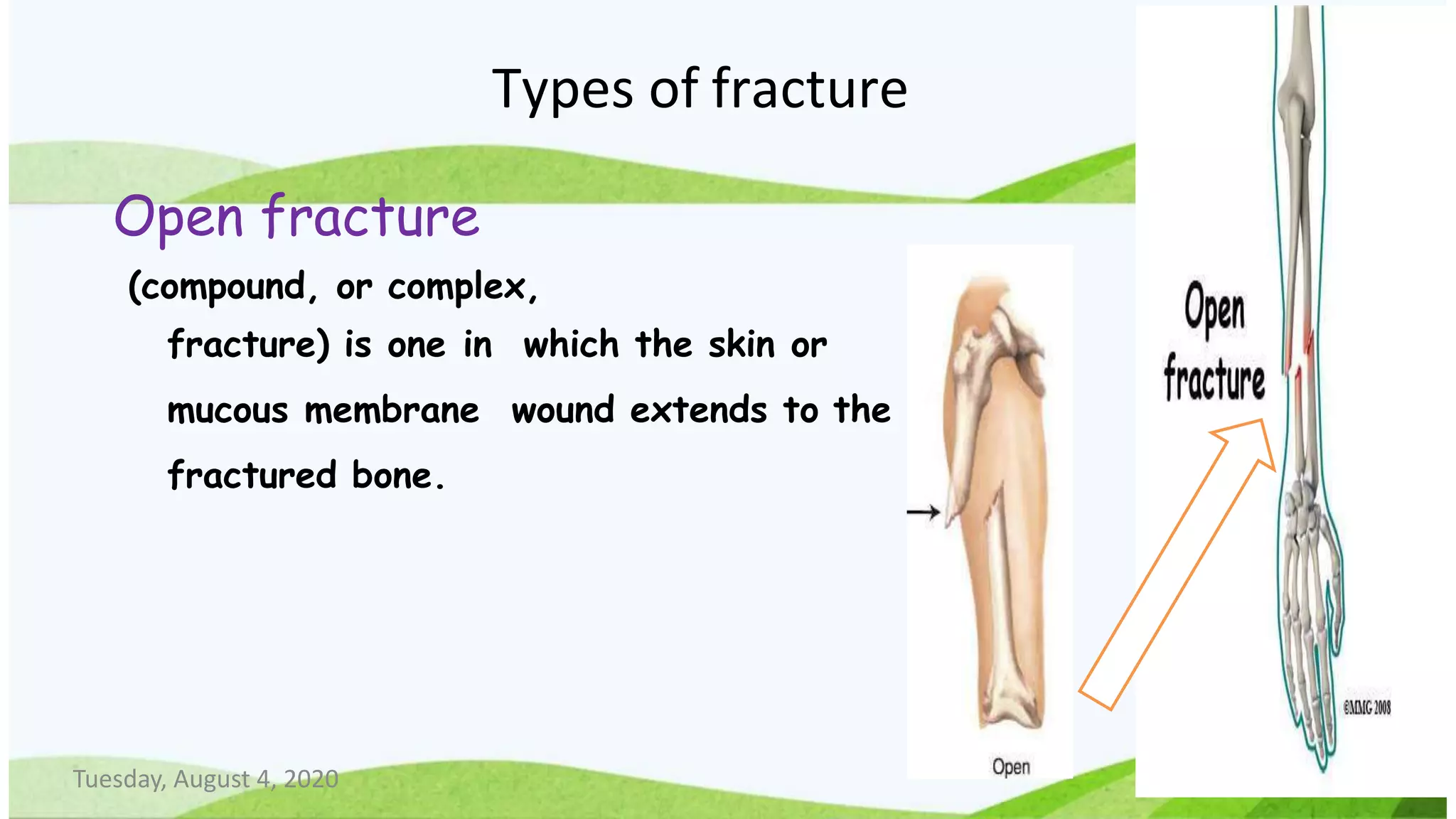 Fracture (Ayoub) | PPTX