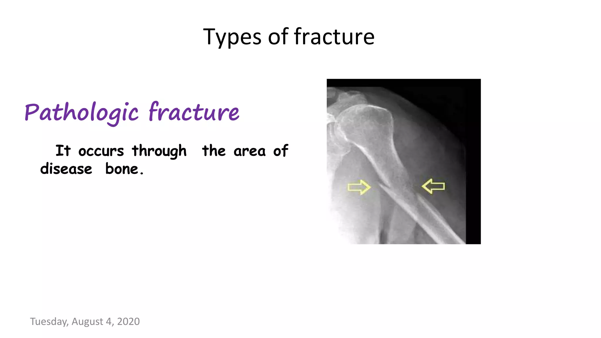 Fracture (Ayoub) | PPTX