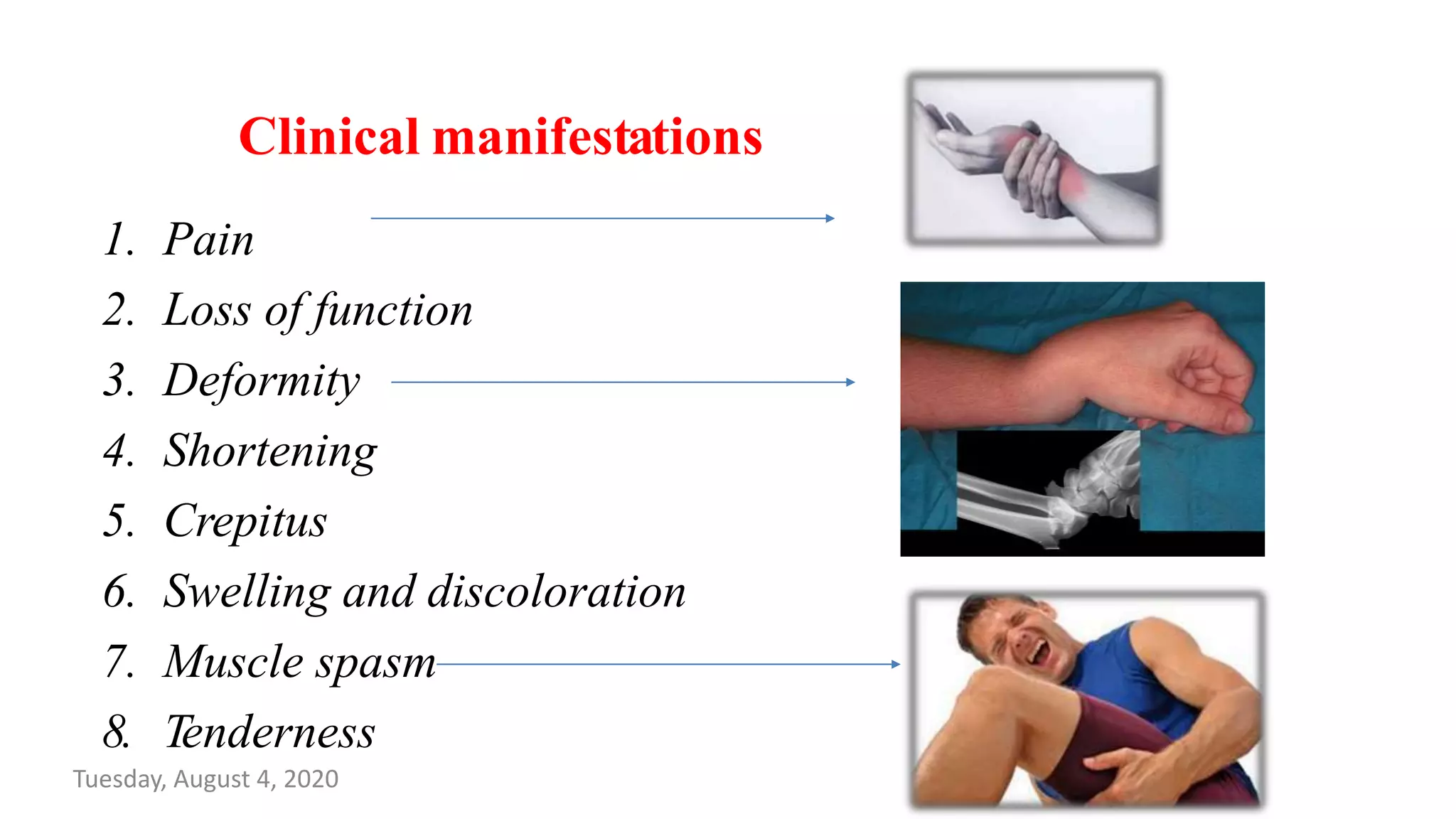 Fracture (Ayoub) | PPTX