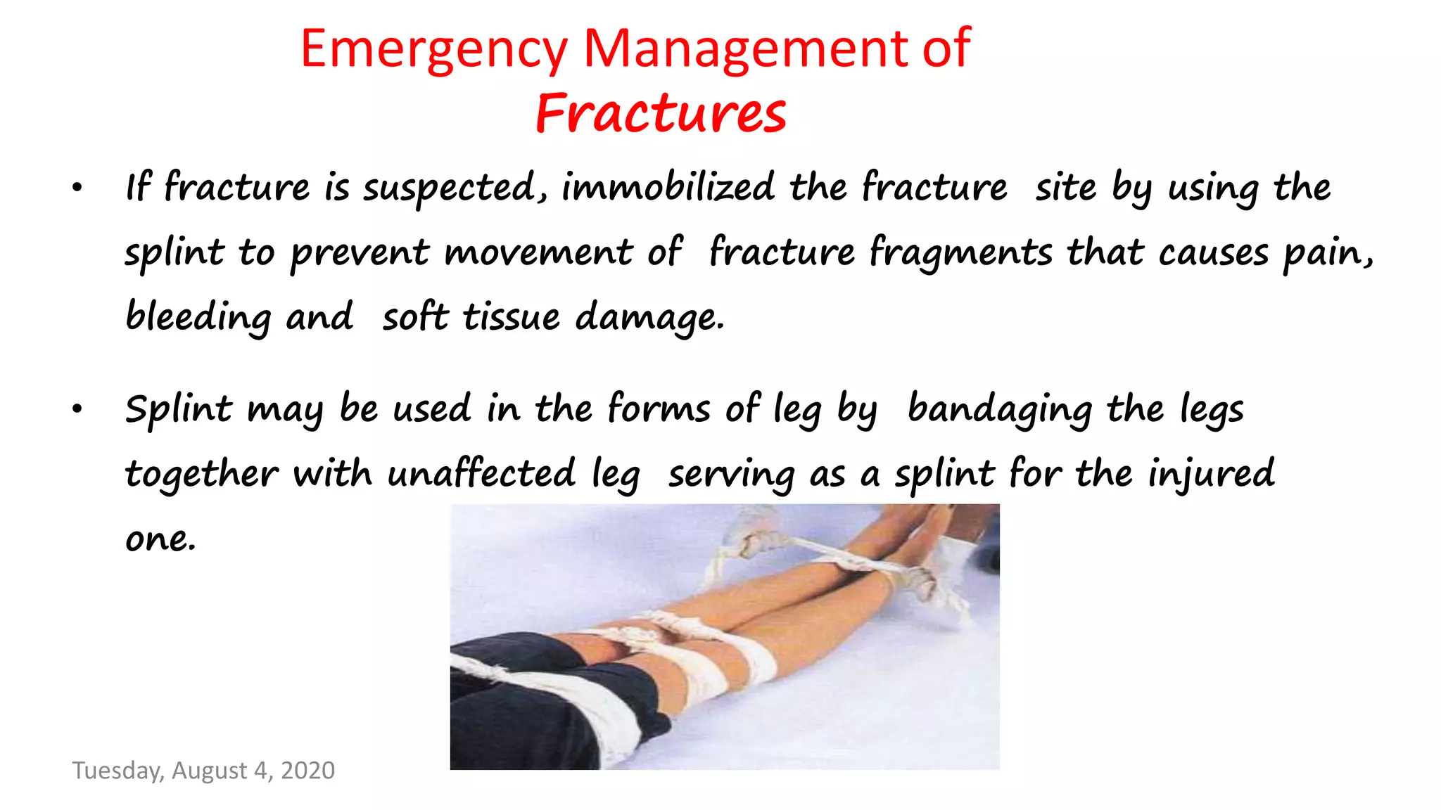 Fracture (Ayoub) | PPTX