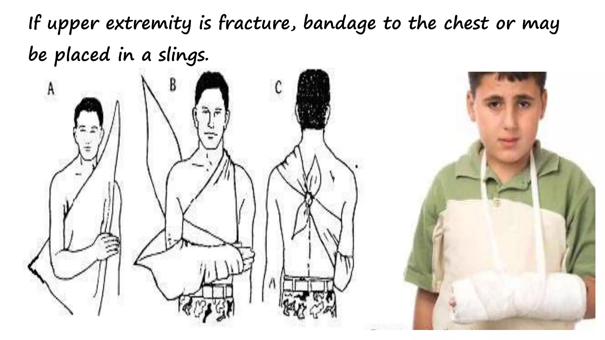 Fracture (Ayoub) | PPTX