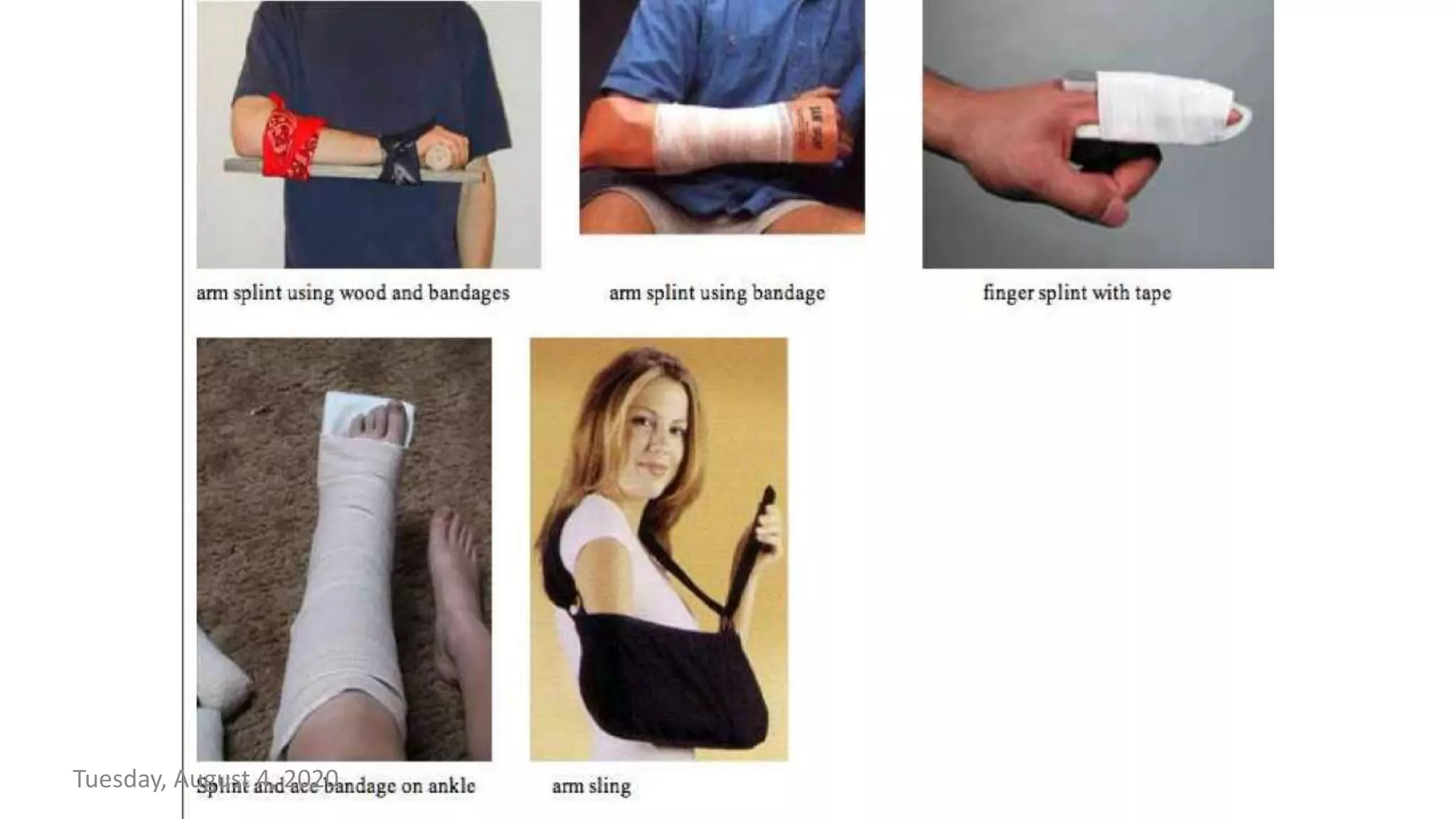 Fracture (Ayoub) | PPTX