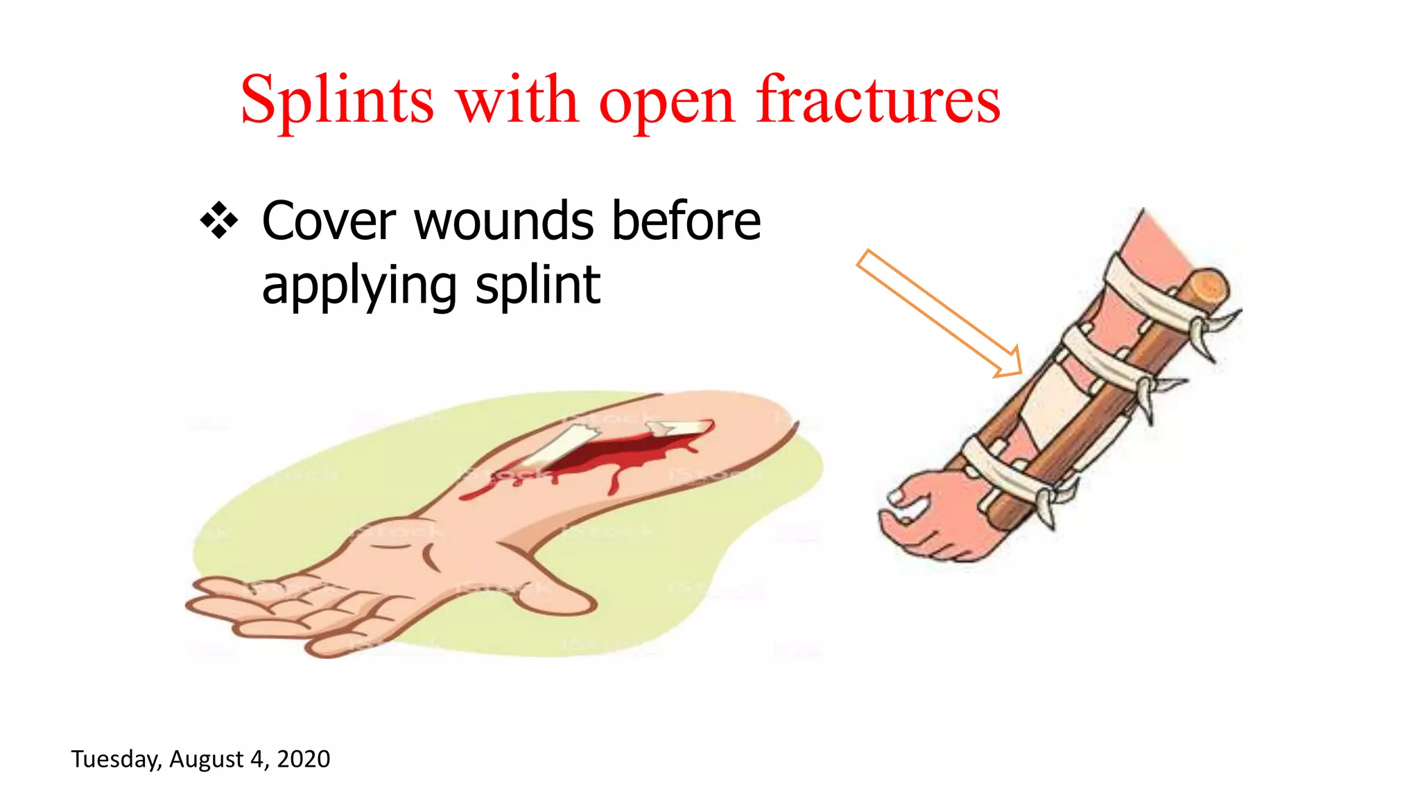 Fracture (Ayoub) | PPTX