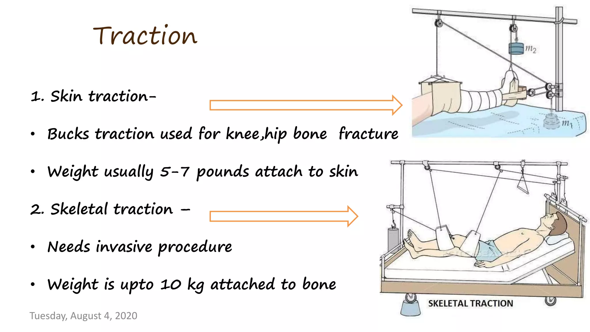 Fracture (Ayoub) | PPTX
