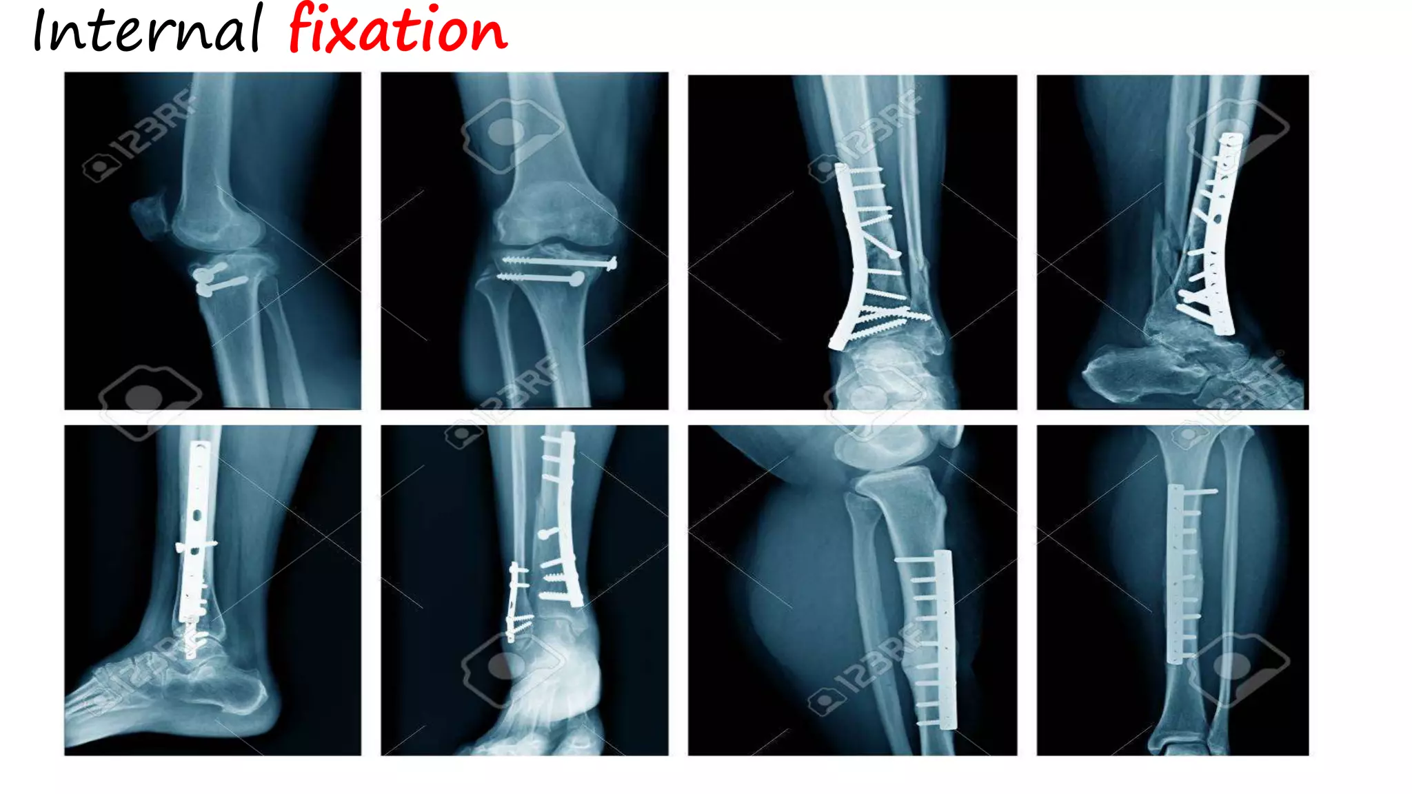 Fracture (Ayoub) | PPTX