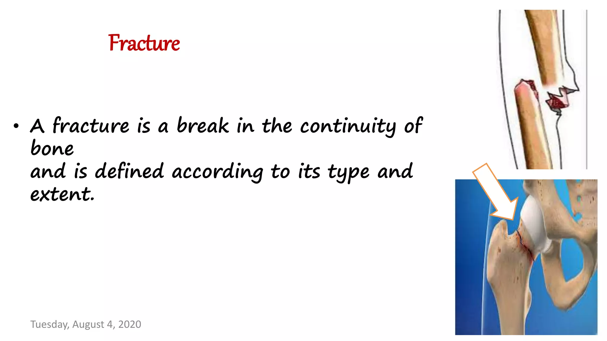 Fracture (Ayoub) | PPTX